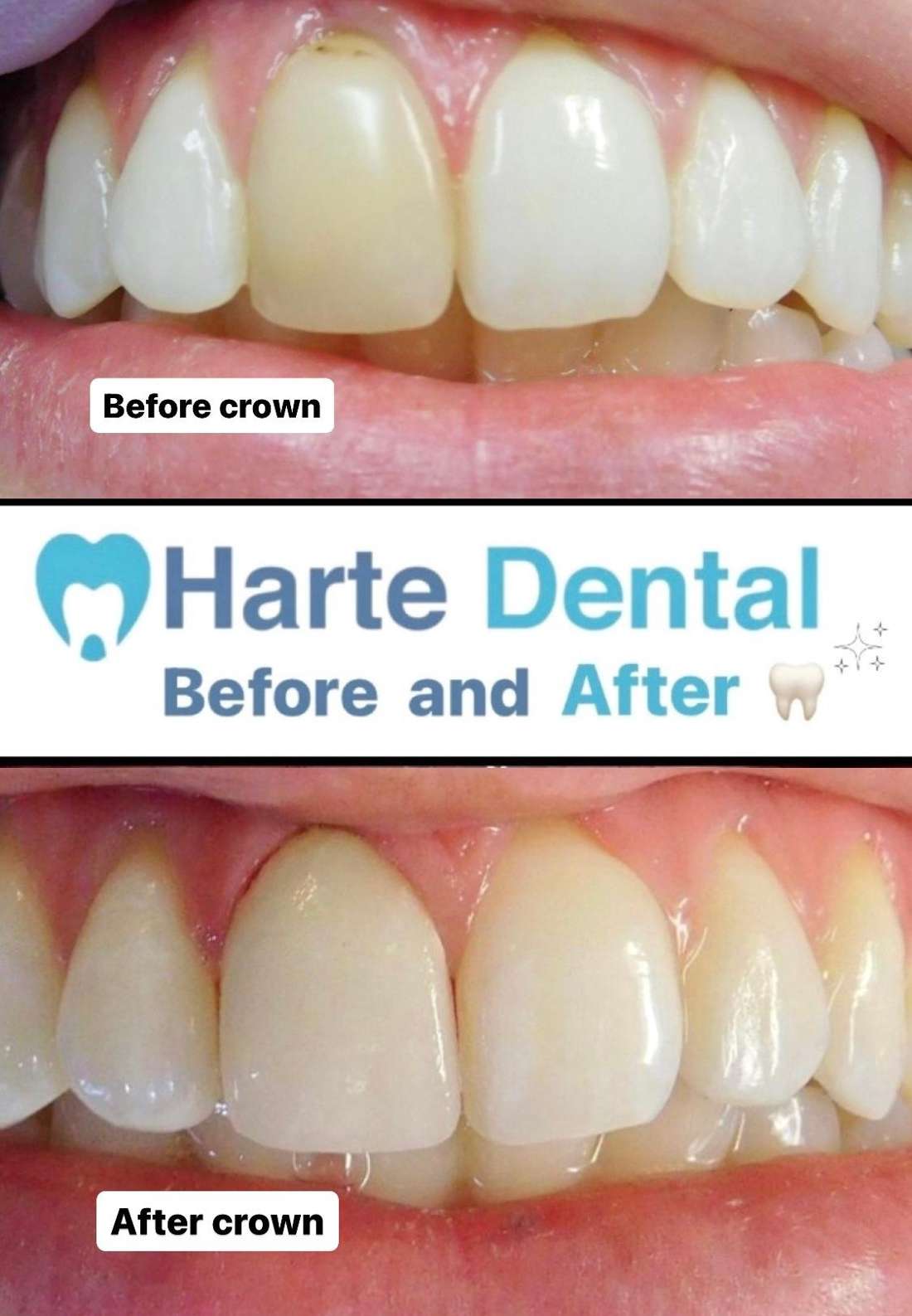 Why Do I Need A Crown Why Are My Gums Peeling Around New Dental